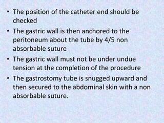 Seminar on stamm, janeway & PE gastrostomy | PPTX