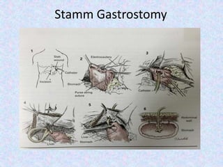 Janeway Gastrostomy Tube