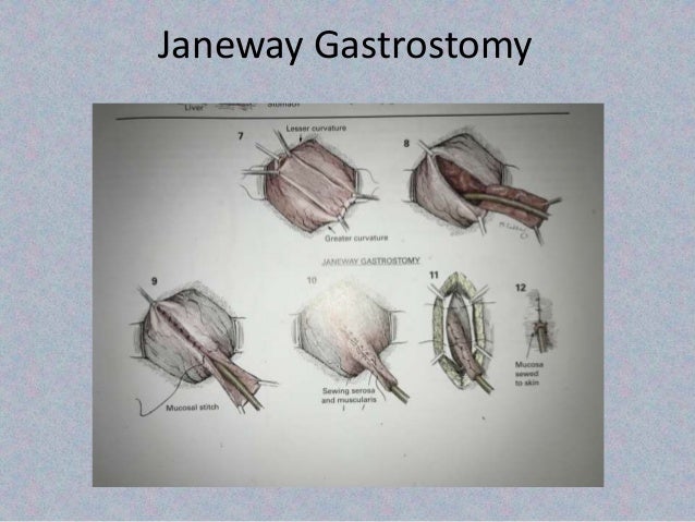 Seminar on stamm, janeway & PE gastrostomy