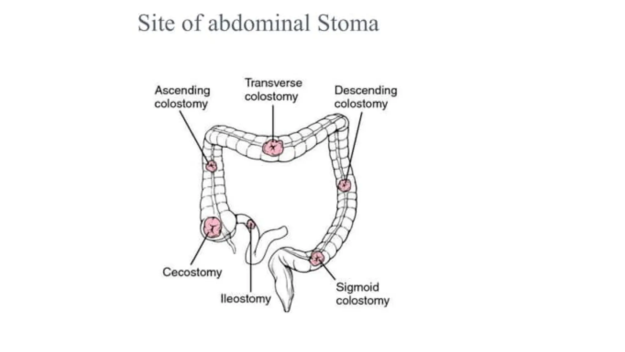 seminar on stoma care and its management.pptx