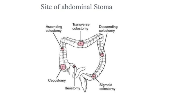 seminar on stoma care and its management.pptx