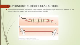 Seminar on suture | PPTX