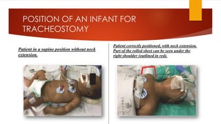 Seminar on Tracheostomy, types and its Complications. | PDF