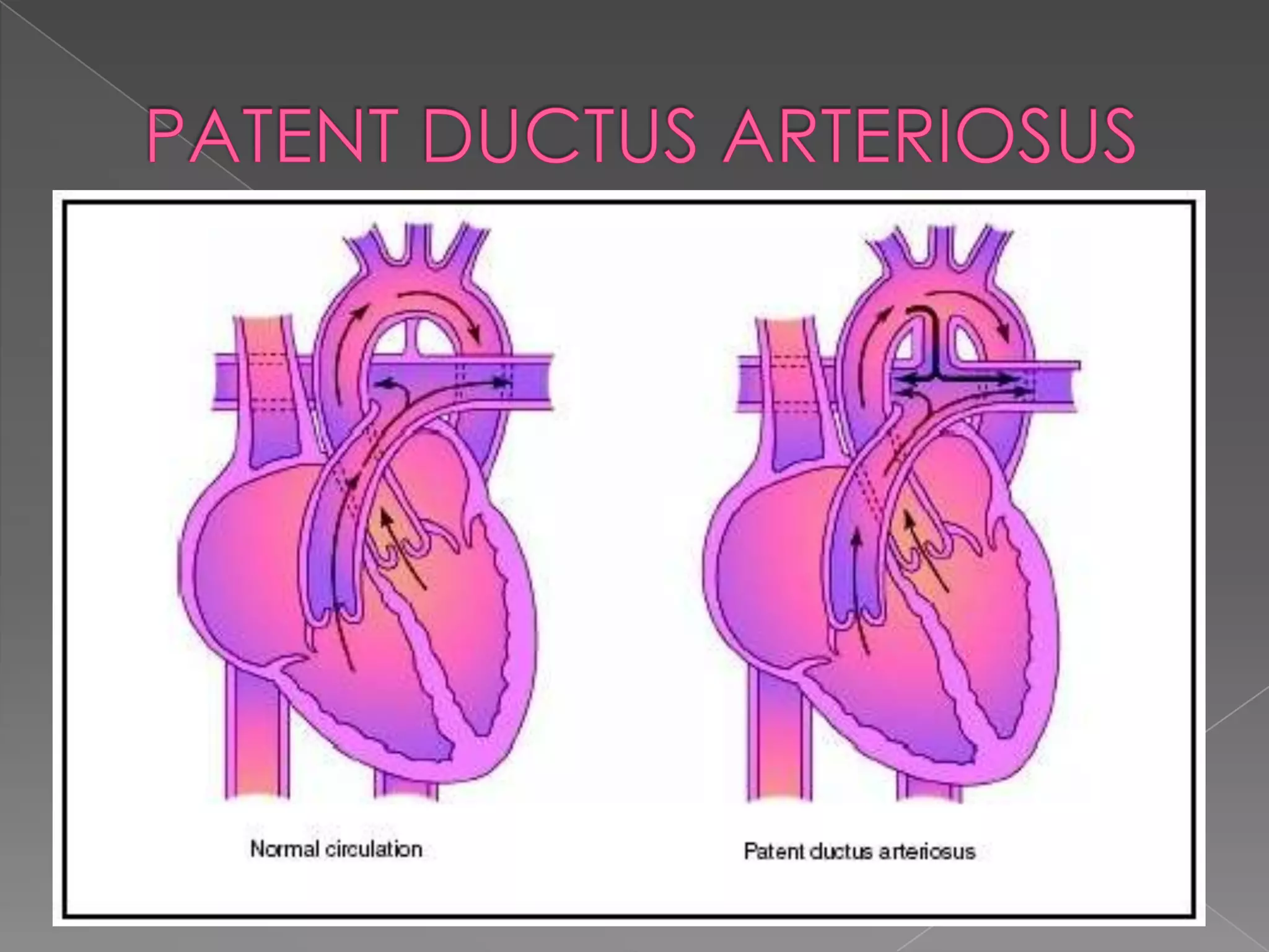 Seminar congenital cardiac disorders (pda,TA and AP Window) | PPT