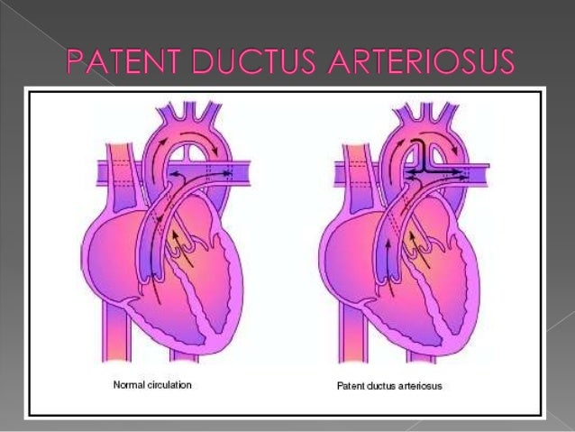 Seminar congenital cardiac disorders (pda,TA and AP Window)