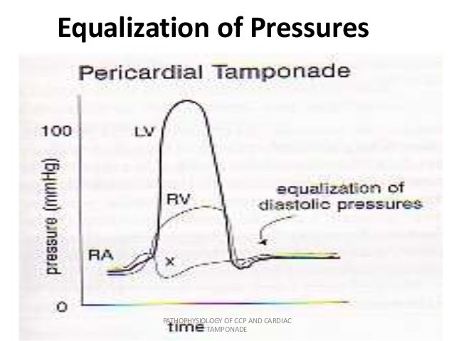 Pathophysiology of ccp and cardiac tamponade