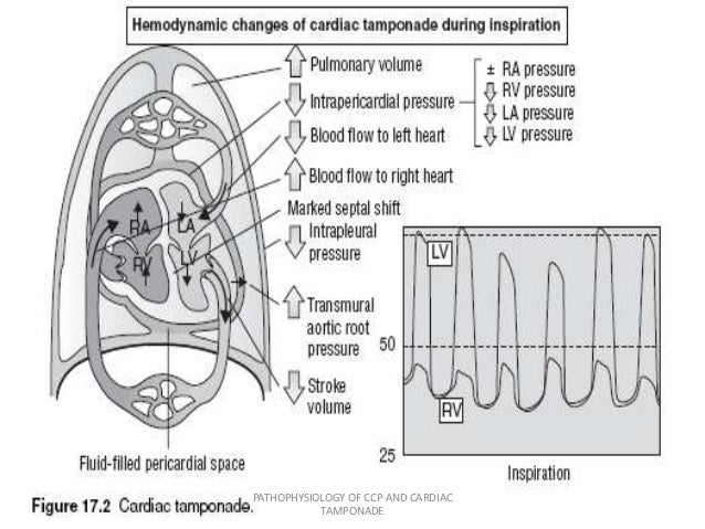 Pathophysiology of ccp and cardiac tamponade
