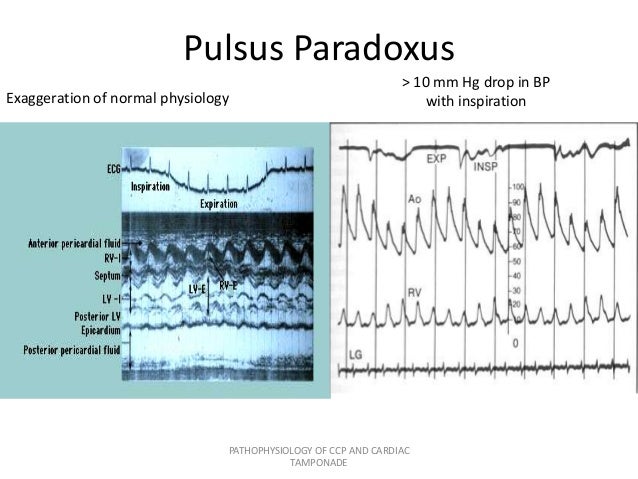 Pathophysiology of ccp and cardiac tamponade