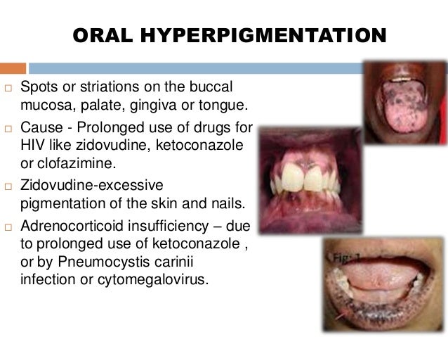 PATHOLOGY AND MANAGEMENT OF PERIODONTAL PROBLEMS IN PATIENTS WITH HIV…