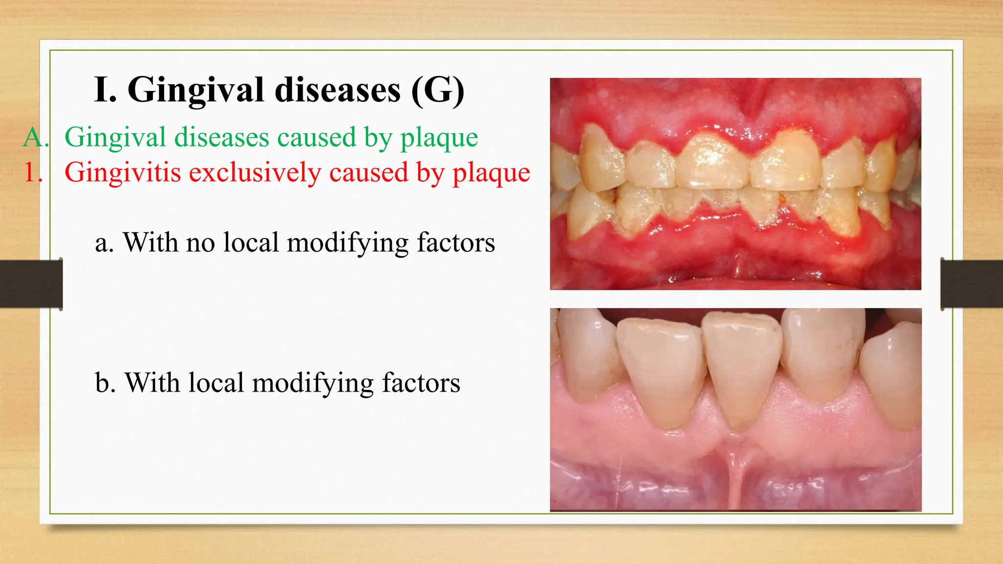 Periodontal diseases classification.pptx