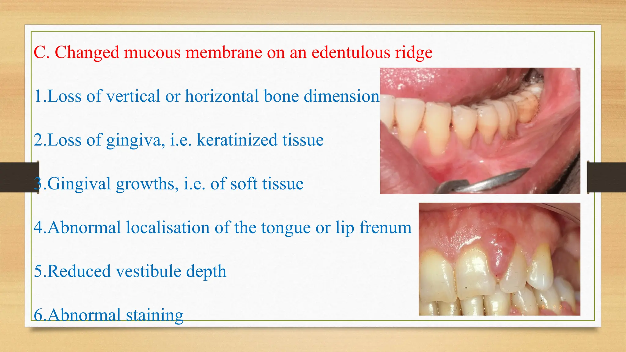 Periodontal diseases classification.pptx | Dental Health | Diseases and ...