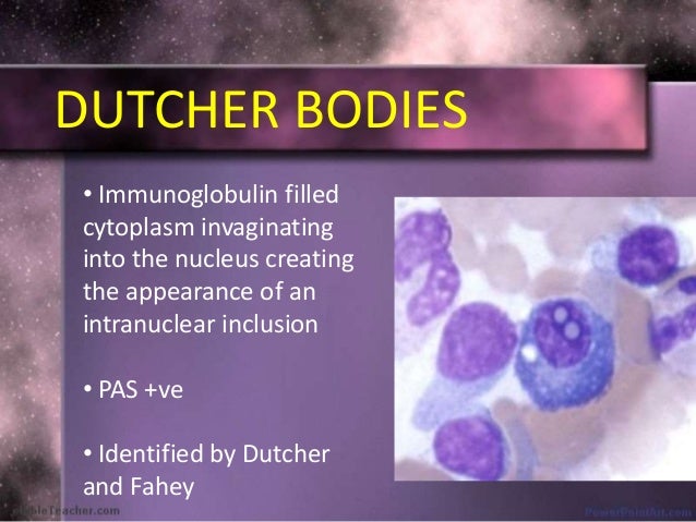 IMWG updates on plasma cell dyscrasias