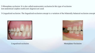 Complete denture and denture material Seminar | PPT