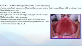 Complete denture and denture material Seminar | PPT