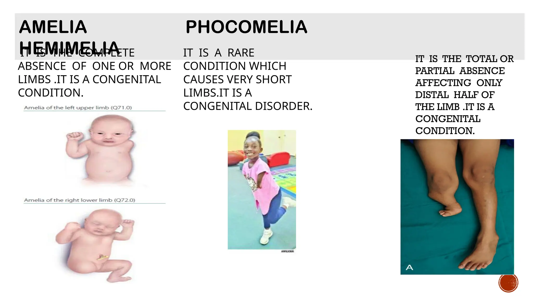 Glance on Amelia, Phocomelia and Hemimelia | PPTX