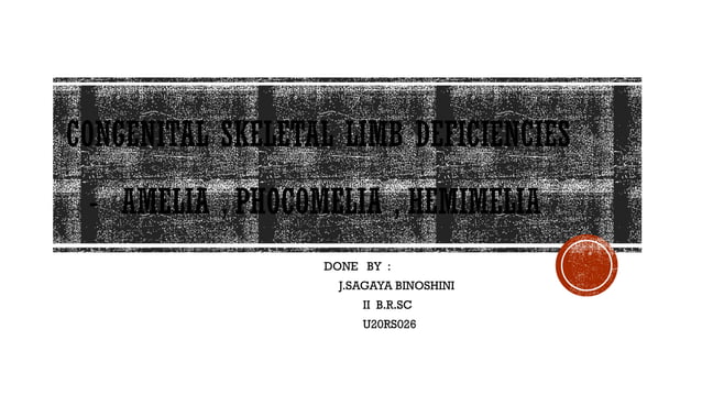 Glance on Amelia, Phocomelia and Hemimelia | PPTX