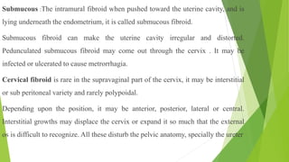 Seminar presentation on uterine fibroid | PPTX