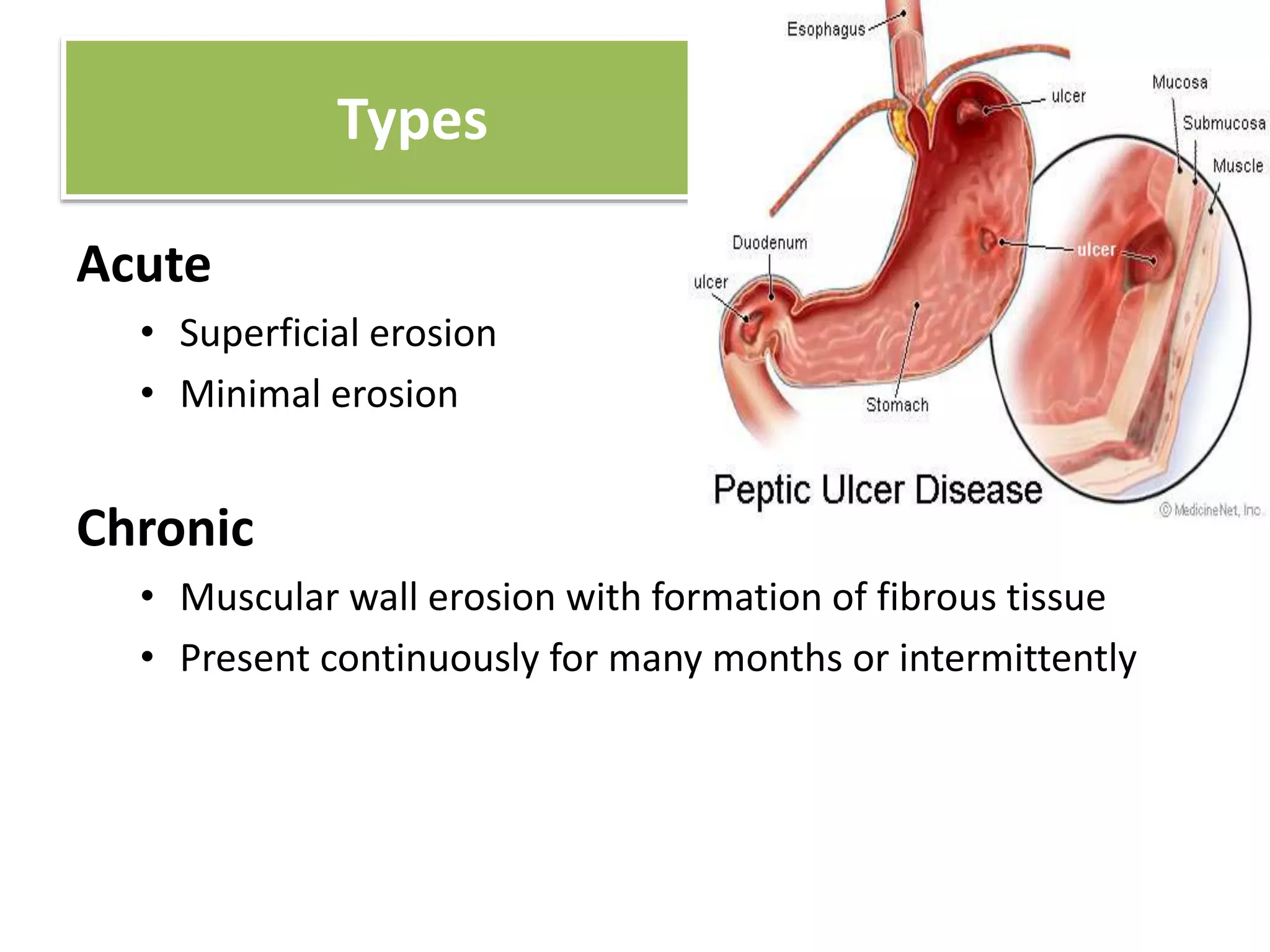 Peptic Ulcer Disease.pptx