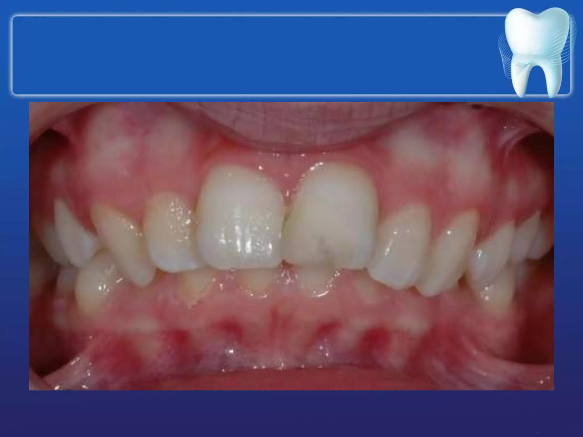 deep bite management | PPTX