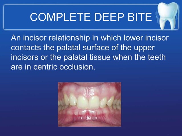 deep bite management | PPTX | Oral care | Personal Care