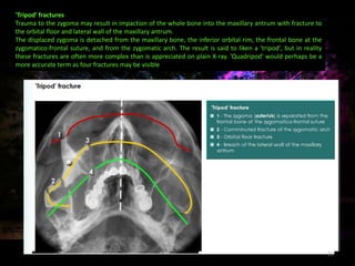 conventional radiography in maxillofacial trauma | PPTX