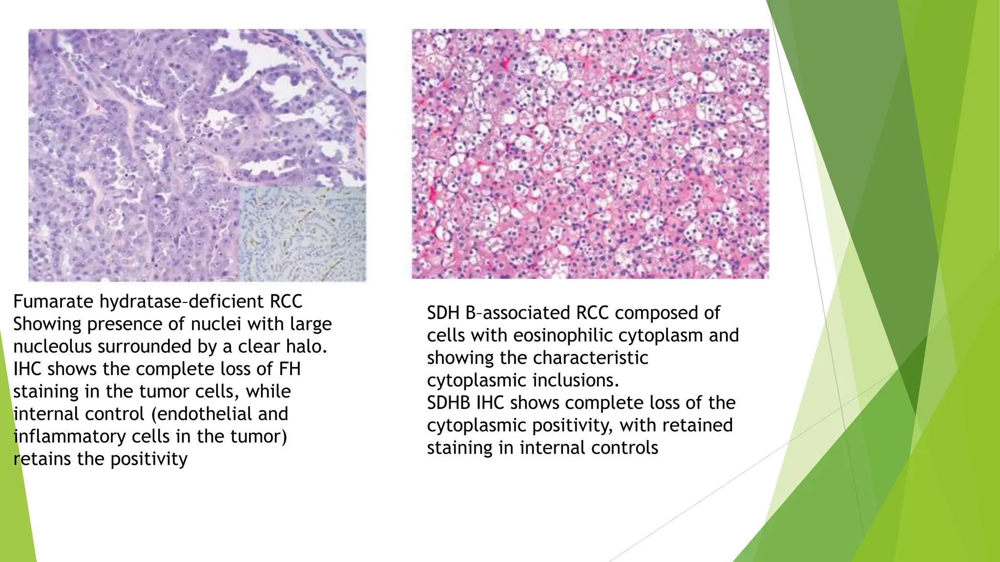 Seminar RKS kidney.pptxkidney slides- pathogenesis features of rcc | PPTX