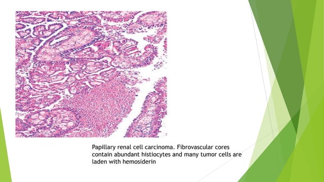Seminar RKS kidney.pptxkidney slides- pathogenesis features of rcc | PPT