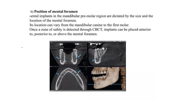 Radiographic imaging in implant drntistry | PPT