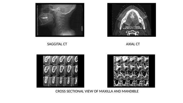 Radiographic imaging in implant drntistry | PPT