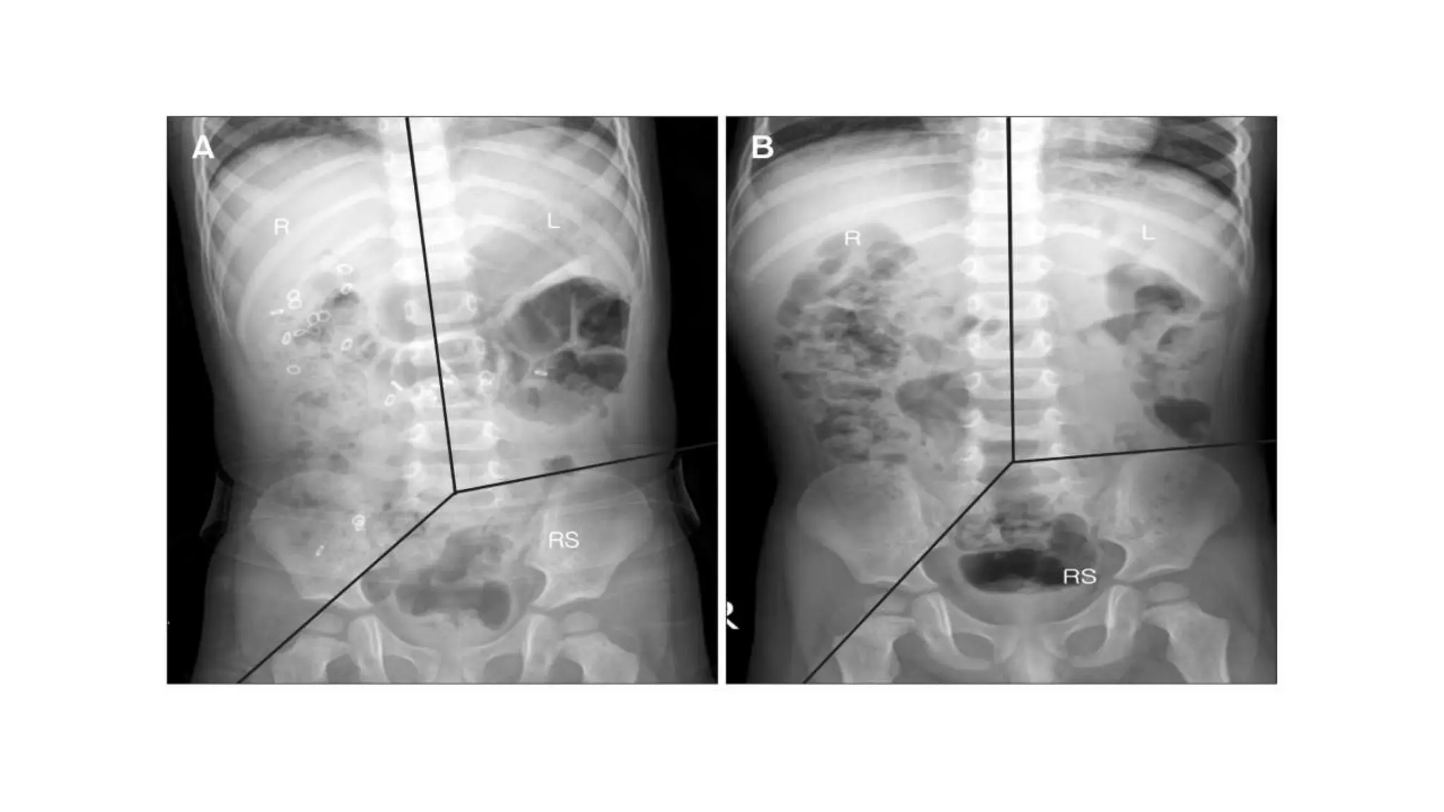 seminar topic- chronic constipation.pptx