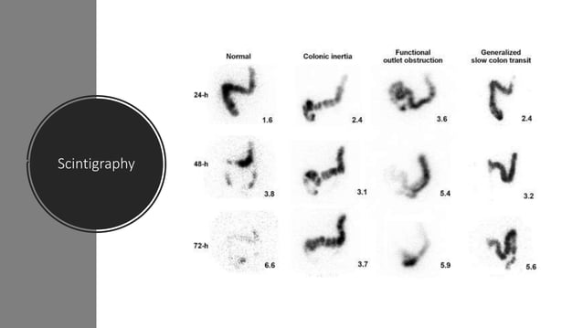 seminar topic- chronic constipation.pptx