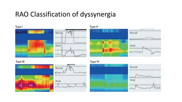 seminar topic- chronic constipation.pptx