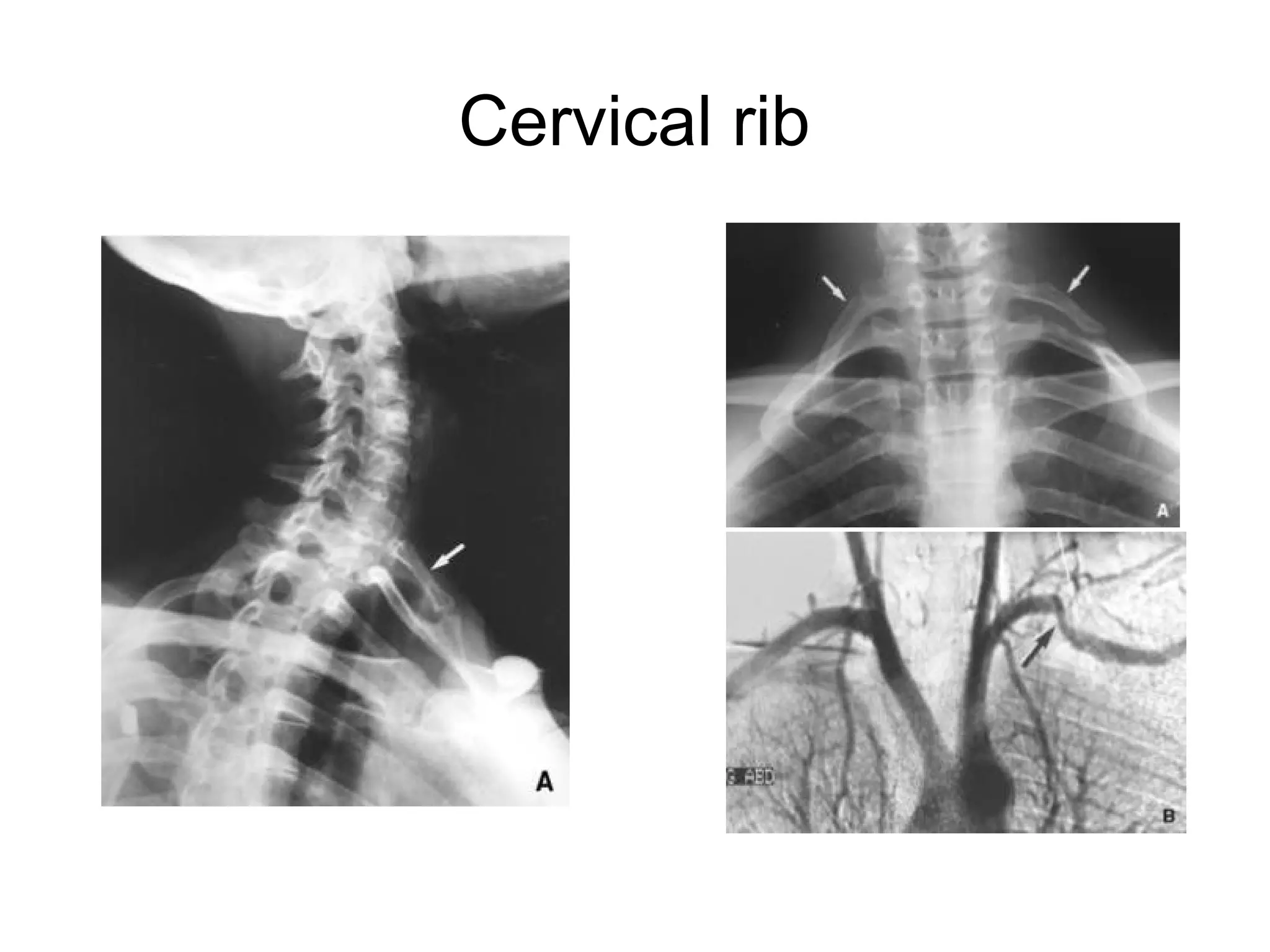 Seminar tos THORACIC OUTLET SYNDROME | PPT