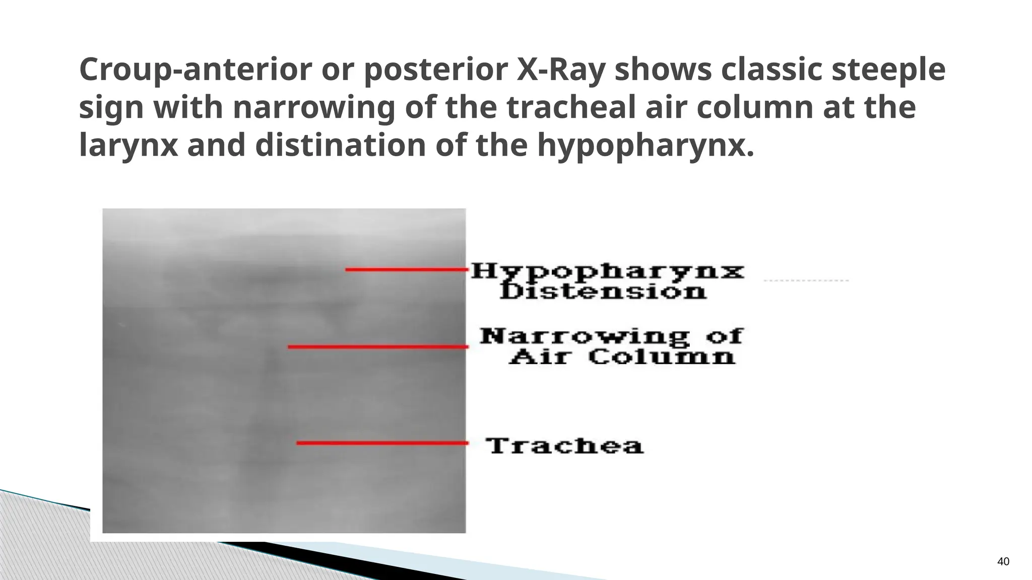 seminar upper airway obstruction edited (1).PPTX