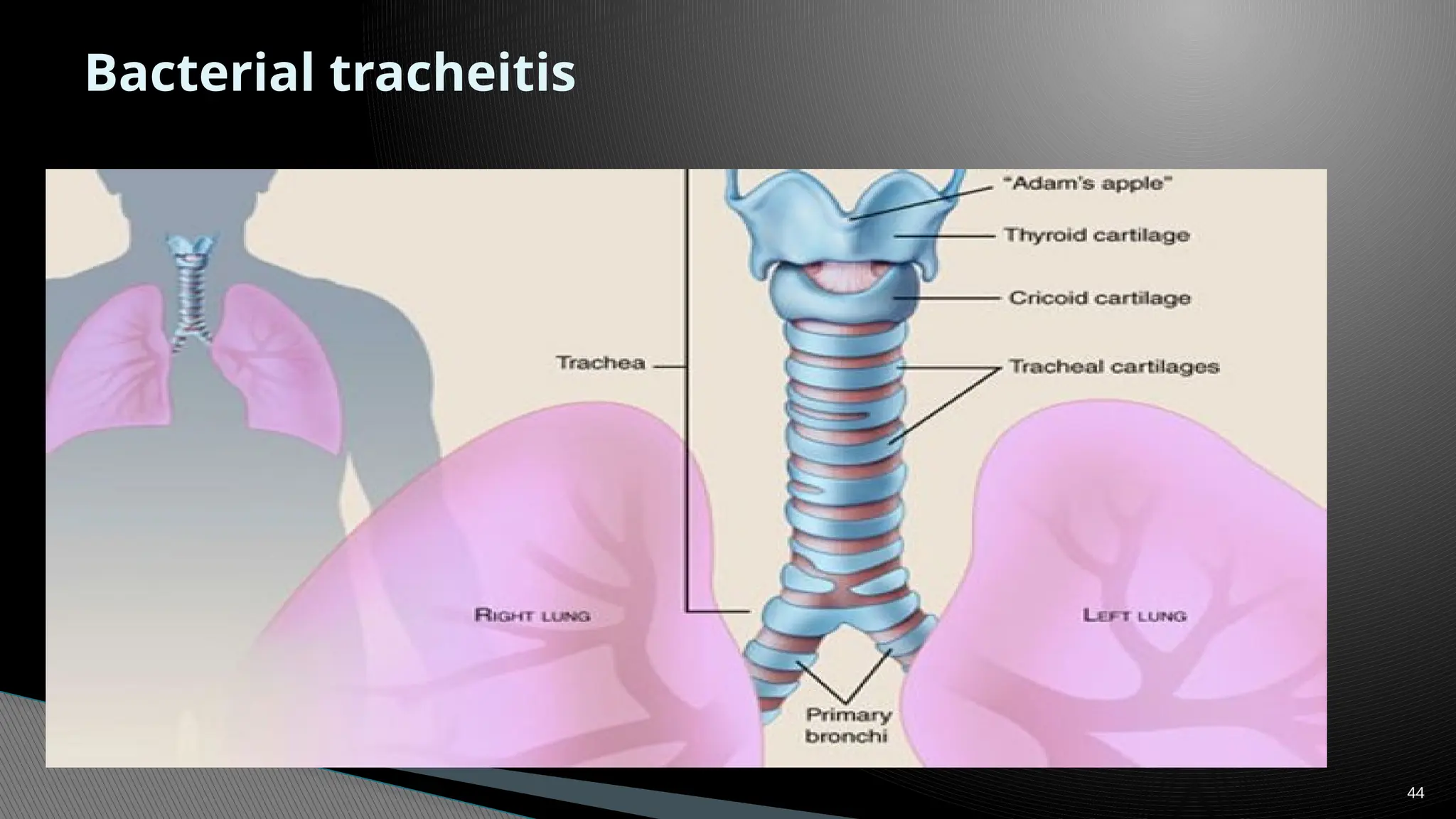 seminar upper airway obstruction edited (1).PPTX