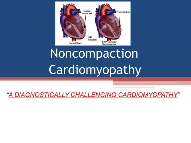 Noncompaction cardiomyopathy | PPTX
