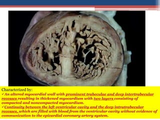 Noncompaction cardiomyopathy | PPTX
