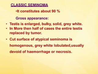 seminoma-190909130212.pptx