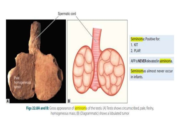 SEMINOMA.pptx ........................... | PPT
