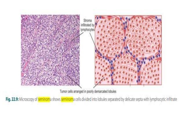 SEMINOMA.pptx ........................... | PPT
