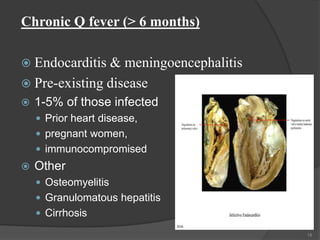 Q-fever | PPTX