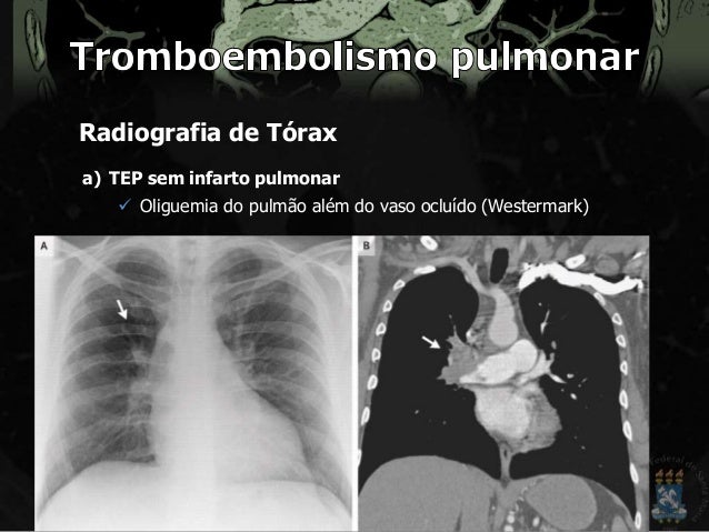 Radiologia Tórax - Dças vasculares pulmonares