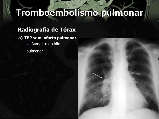 Radiologia Tórax - Dças vasculares pulmonares