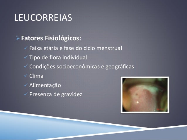 Seminário leucorréias -UNIR