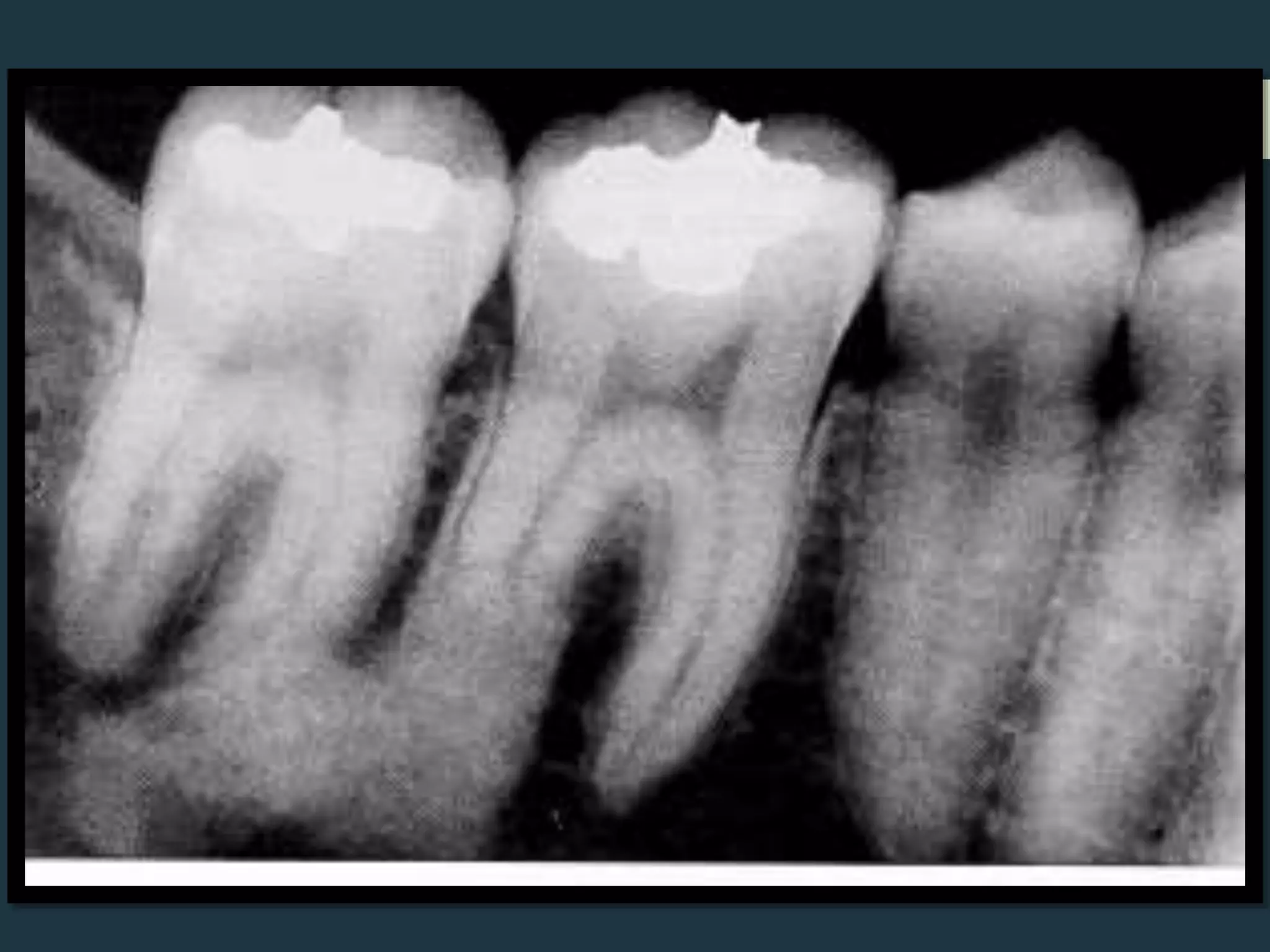 Osteomielite crônica esclerosante focal