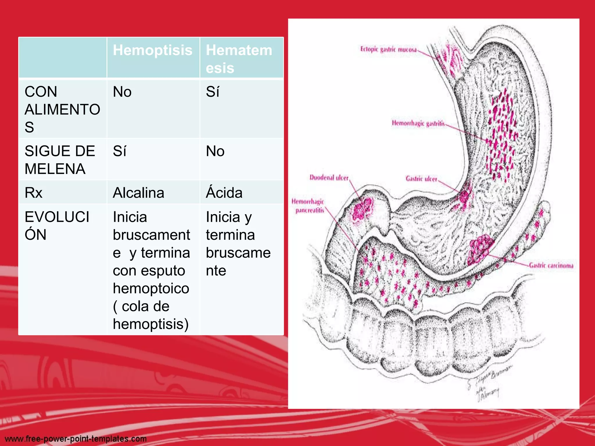 Semio de hemoptisis | PPT