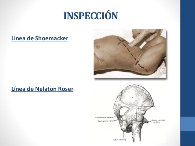 Semiogia de cadera - Ortopedia y Traumatologia