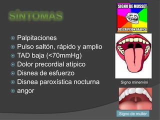 Semiología de insuficiencia aórtica | PPTX