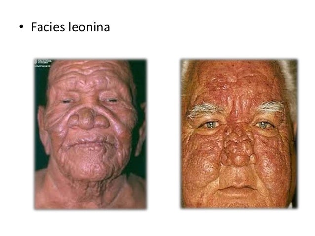 Facies Leonina