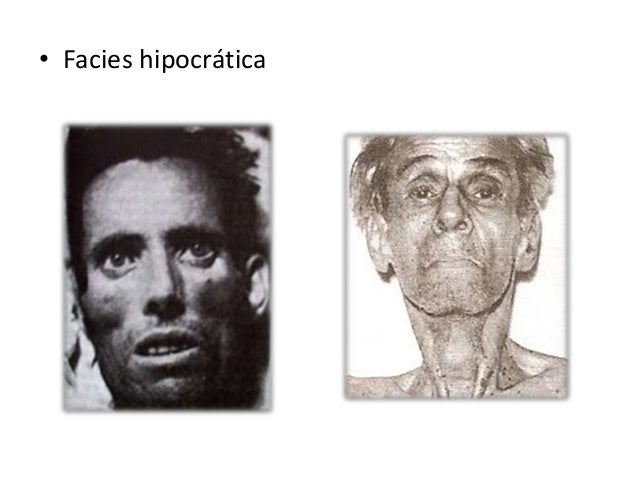 Facies Hippocratica